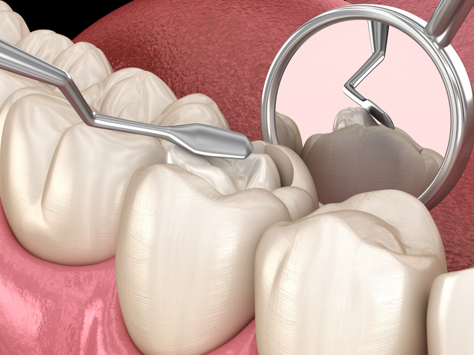 Safe Amalgam Removal Plymouth | Replace With White Fillings