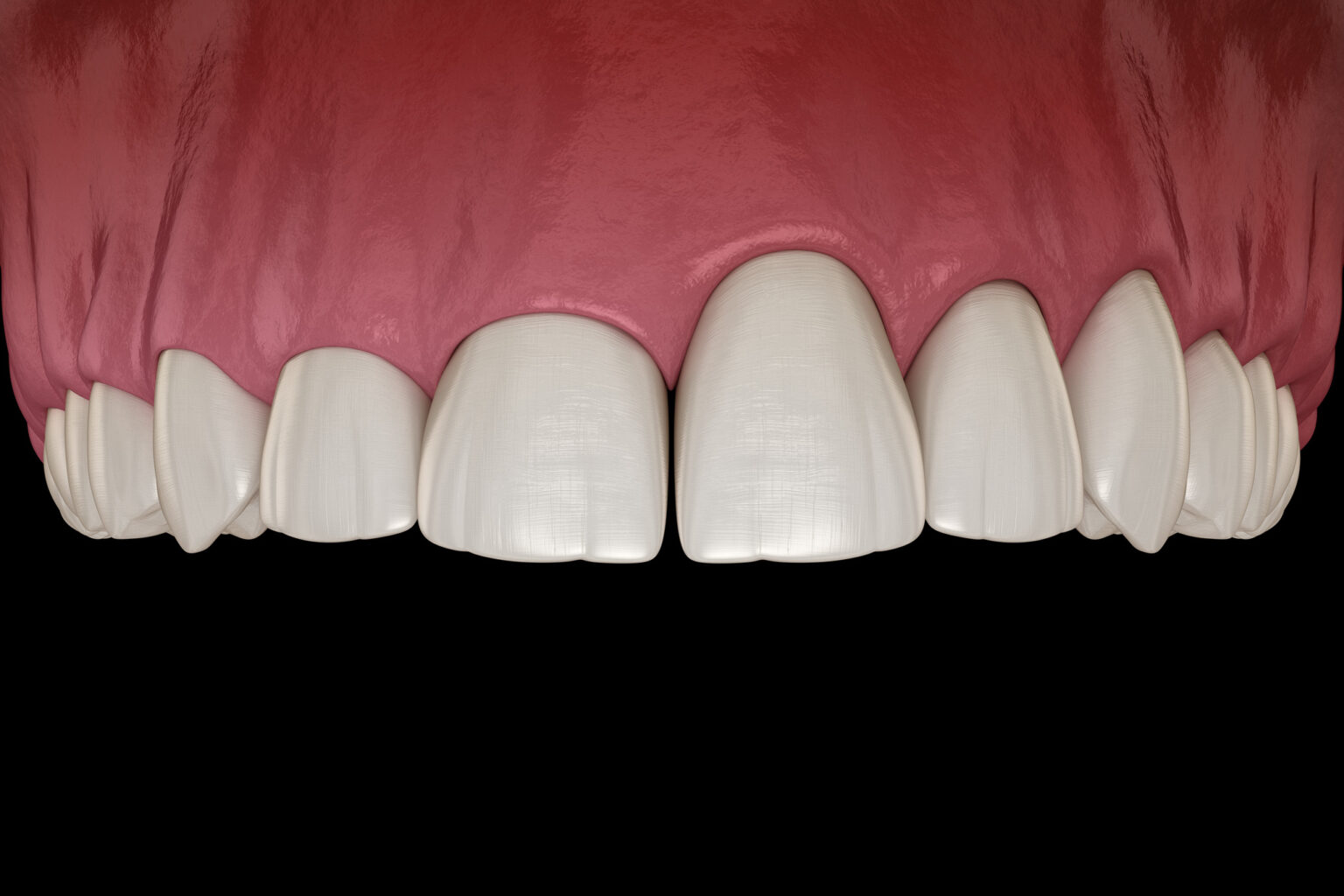 Gum Contouring Plymouth - Tooth Contouring - Laser Gum Reshaping ...